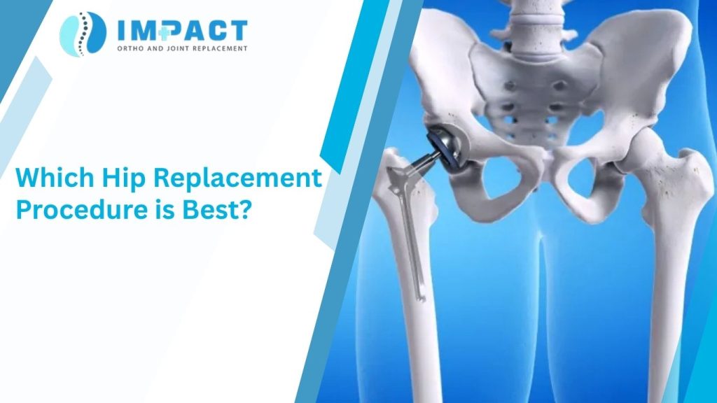 Which Hip Replacement Procedure is Best? - Impact Orthopedic Center